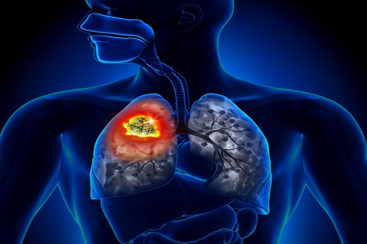  Lung Cancer In Hindi